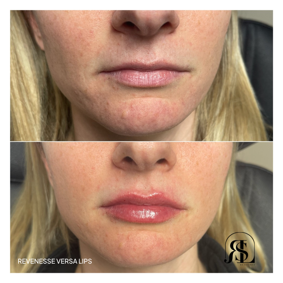 Lip Filler Before and After: What’s the Difference? — Refine Laser ...