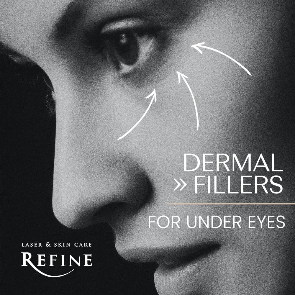 How Dermal Fillers Can Fill In Your Tear Troughs — Refine Laser & Skin Care
