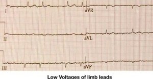 ECG 101: The ECG Paper Explained — The PR Segment.com