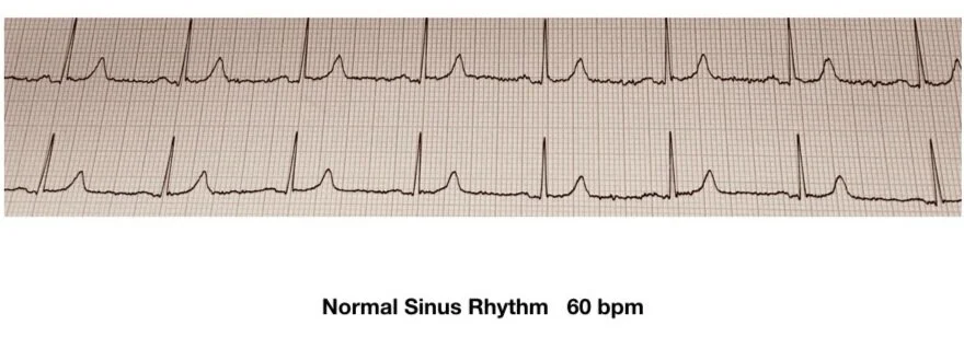ECG 101: The ECG Paper Explained — The PR Segment.com