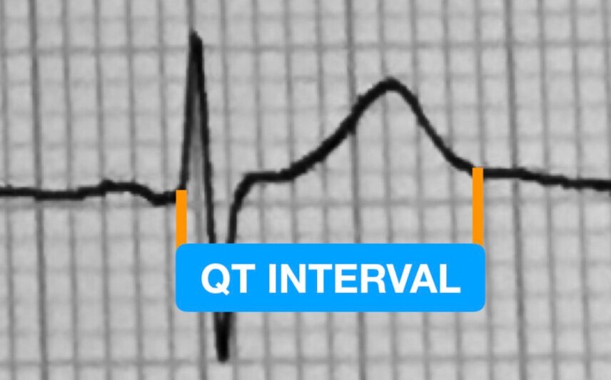 ECG Segments and Intervals — The PR Segment.com