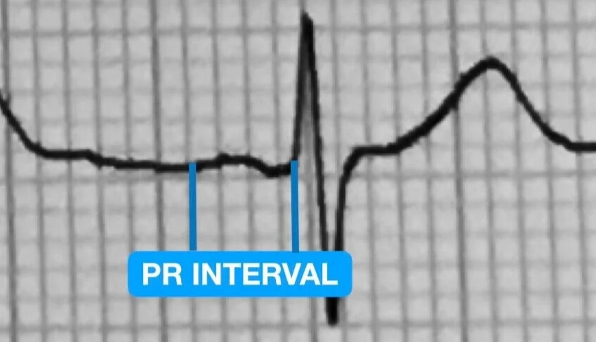 ECG Segments and Intervals — The PR Segment.com