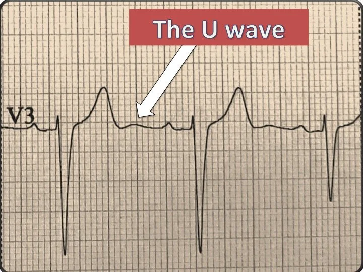 ECG 101 The ECG Paper Explained The PR Segment ECG 101 The ECG Paper Explained The PR Segment