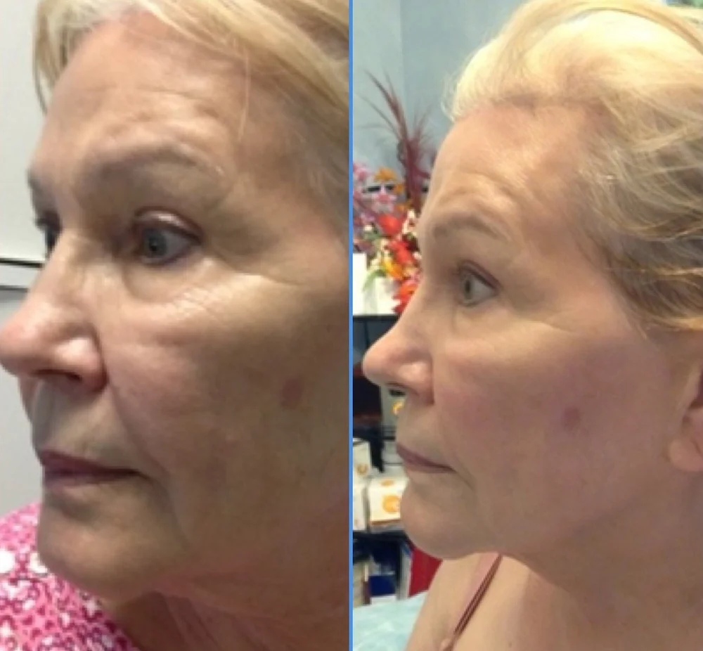 Endosphères Therapy | Awaken Now Acupuncture & Wellness — Awaken Now ...