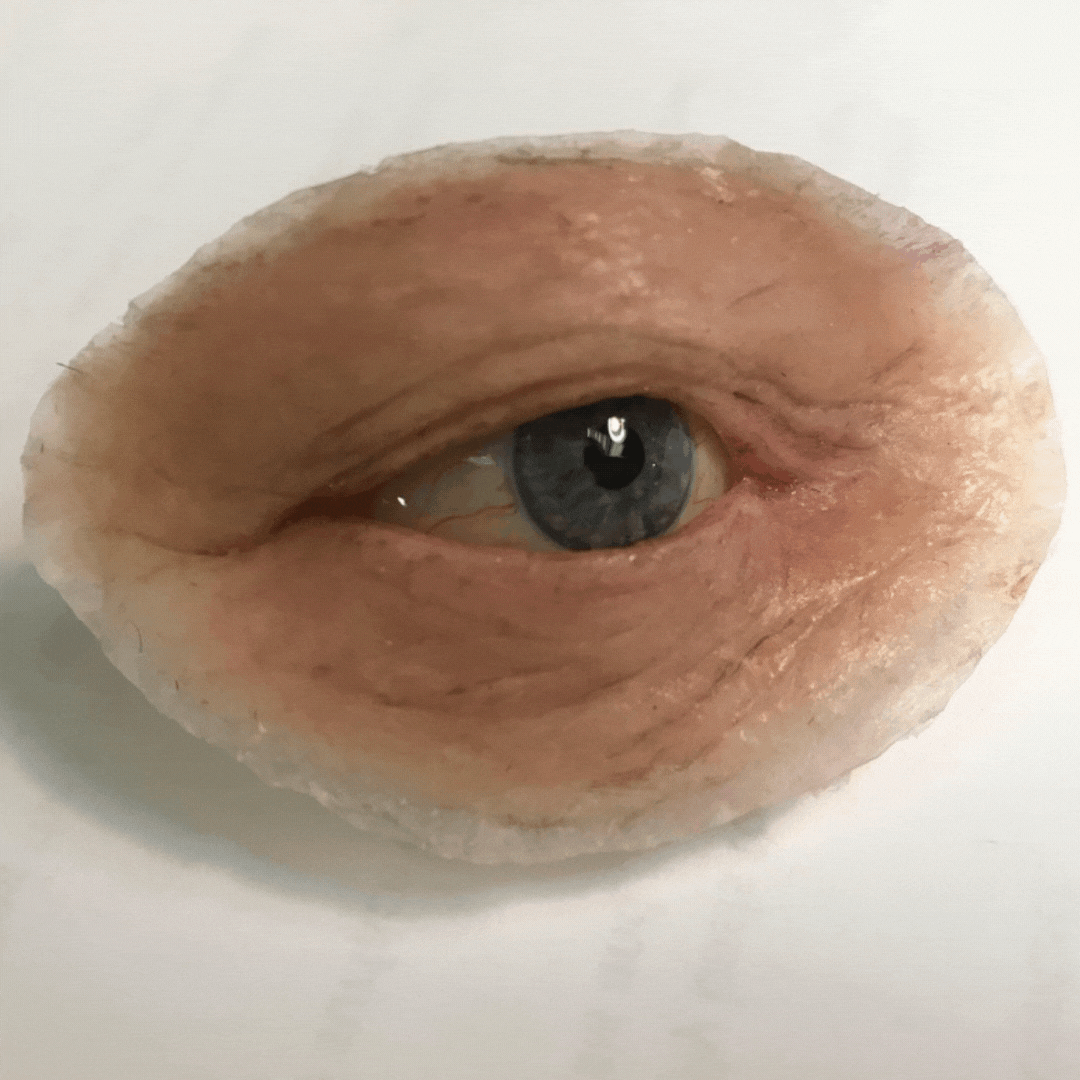 Maxillofacial Prostheses New York | Facial Prosthesis | Pre-Prosthetic ...