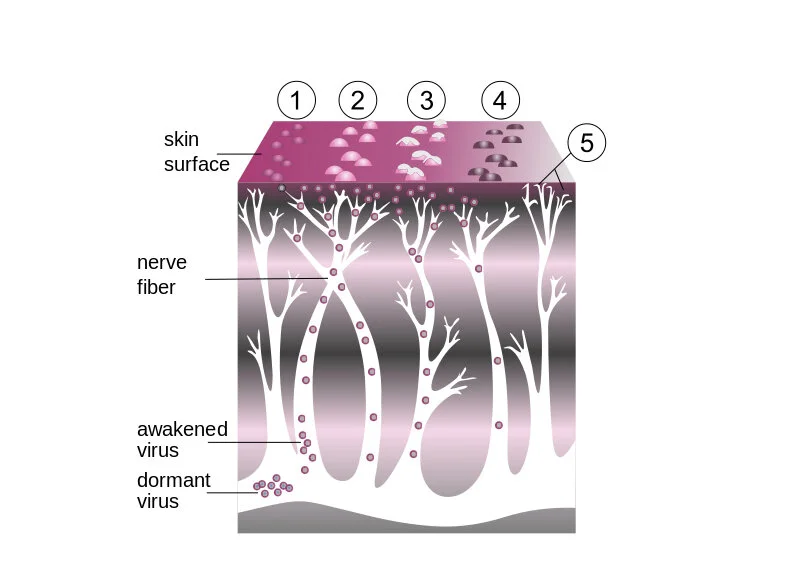 CHICKENPOX TO SHINGLES: YOUNG TO OLD AND HOW VACCINES CHANGED THE GAME ...