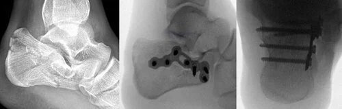 Fracture Surgeries — Dr. Andrew Marsh