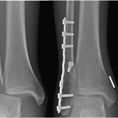 Fracture Surgeries — Dr. Andrew Marsh