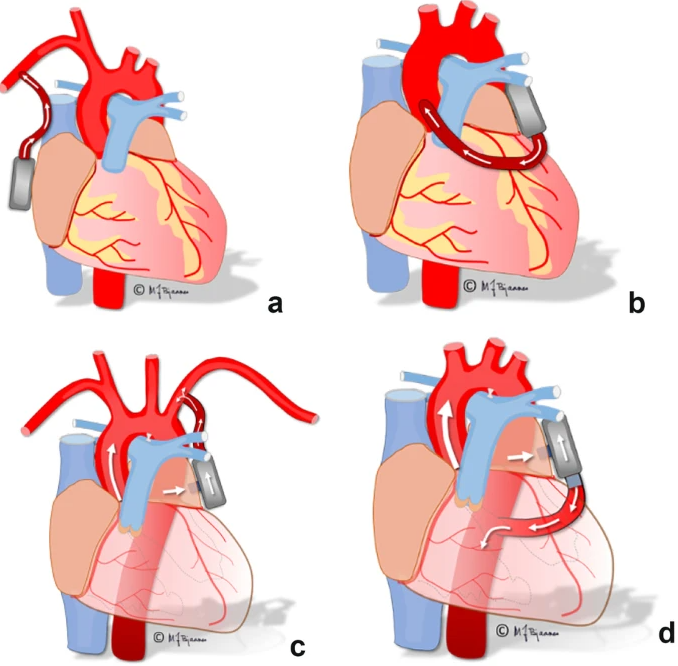 Stats + Facts — Cardiost - LAUD or Left Atrium Unloading Device