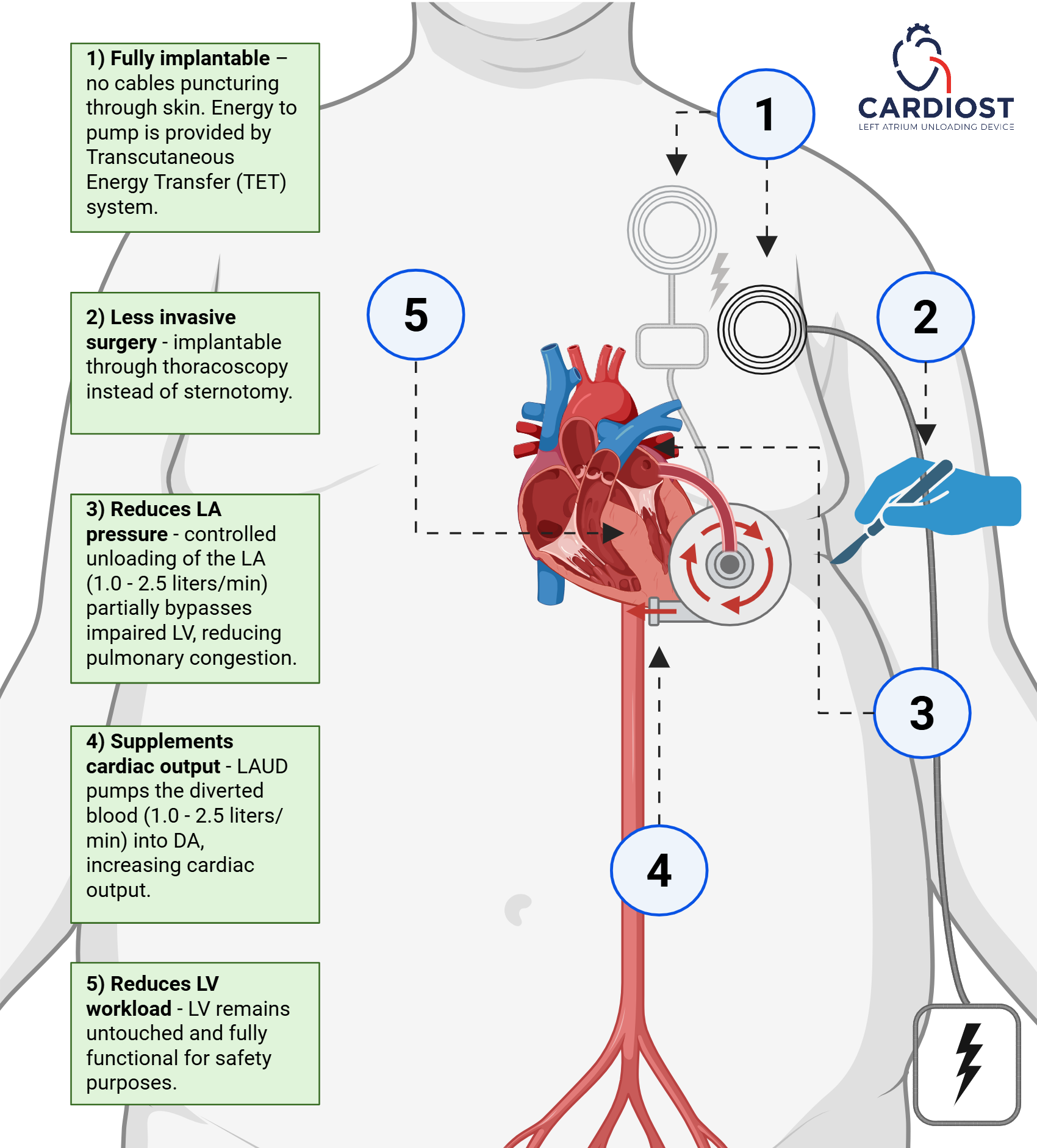 LAUD — Cardiost - LAUD or Left Atrium Unloading Device