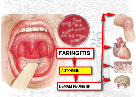 faringitis kronis / radang- enggorok kronis — Dokter Spesialis THT ...