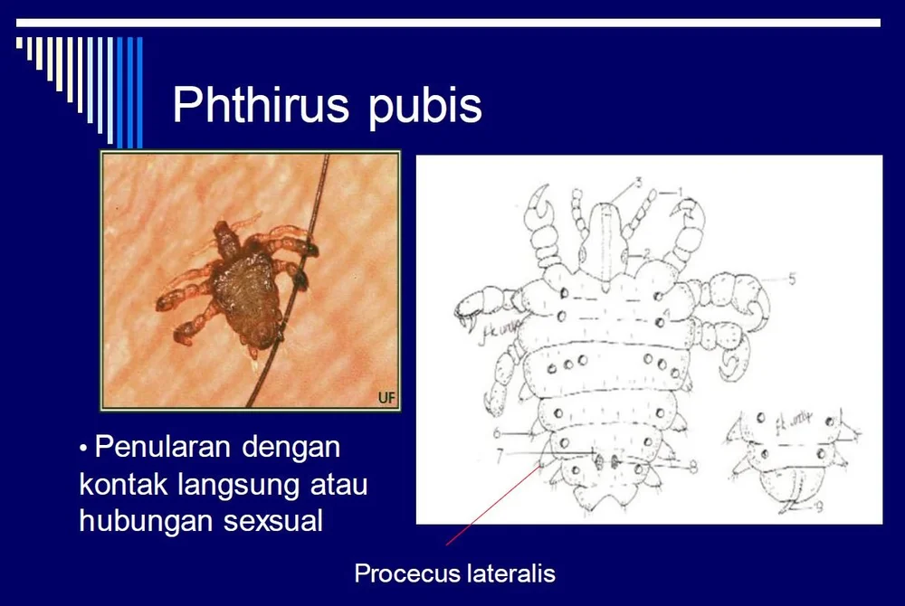 Empat ektoparasit yang umum menginfestasi manusia dan menyebabkan ...