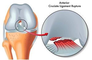 Patient Info / Lateral Extra-Articular Tenodesis — Dr Keran Sundaraj