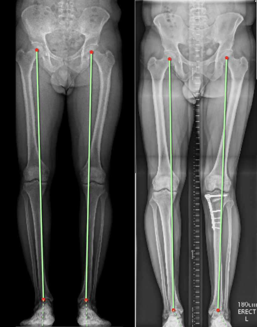 Patient Info / HTO High Tibial Osteotomy — Dr Keran Sundaraj