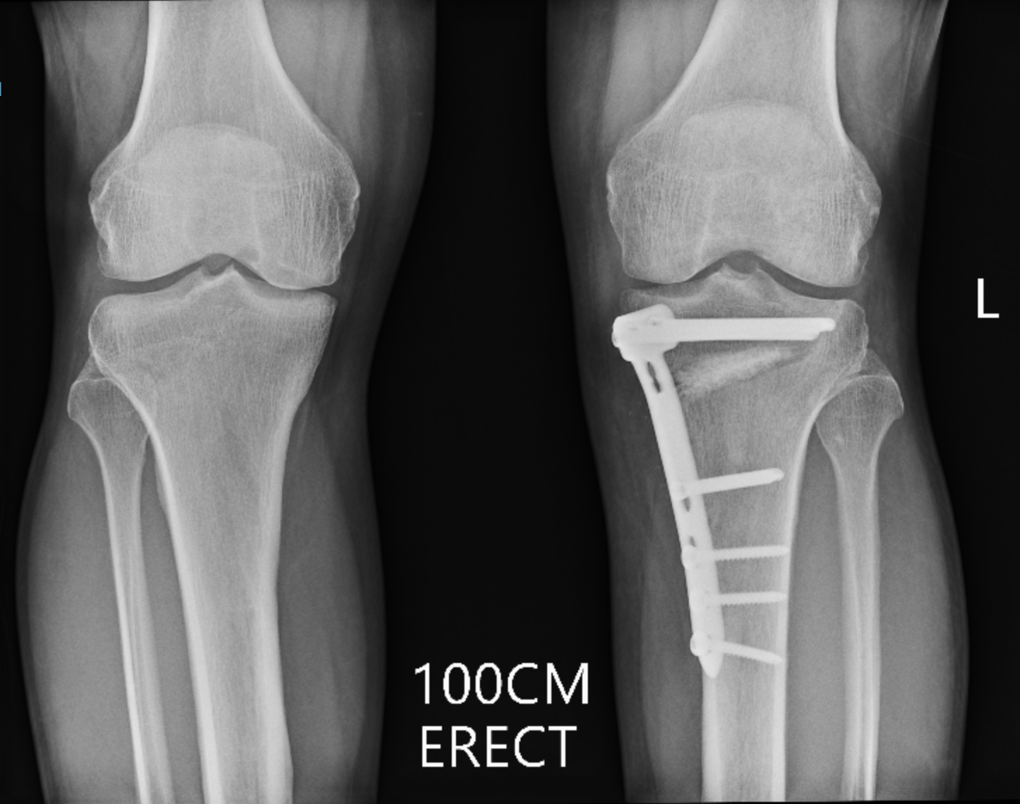 Patient Info / HTO High Tibial Osteotomy — Dr Keran Sundaraj