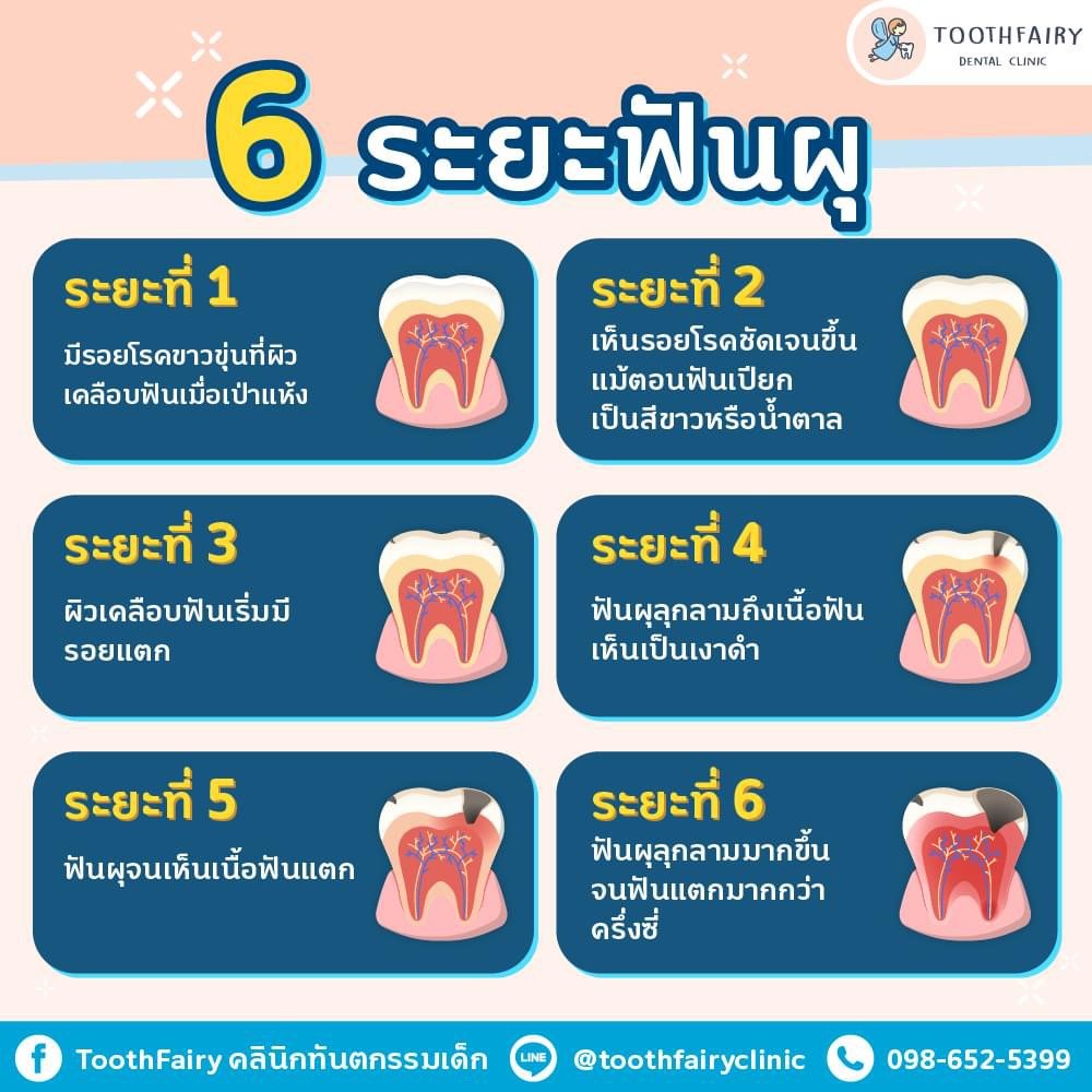 เด็กฟันผุ อุดฟันน้ำนมมีประโยชน์อย่างไร? (ราคาเท่าไหร่) | ToothFairy ทัน ...
