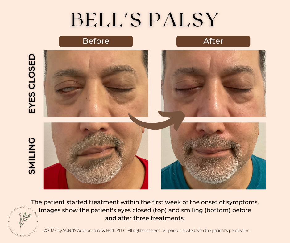 Bell s Palsy Meaning In Chinese At Adolph Grier Blog Bell s Palsy Meaning In Chinese At Adolph Grier Blog
