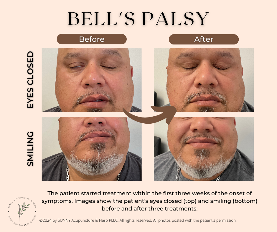 Bell's Palsy — SUNNY Acupuncture & Herb