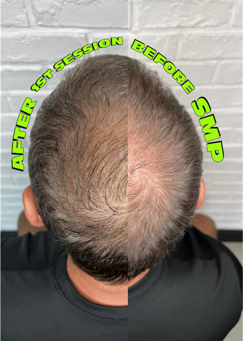 What is Scalp Micropigmentation: The Pros & Cons of Hair Loss Tattoos ...