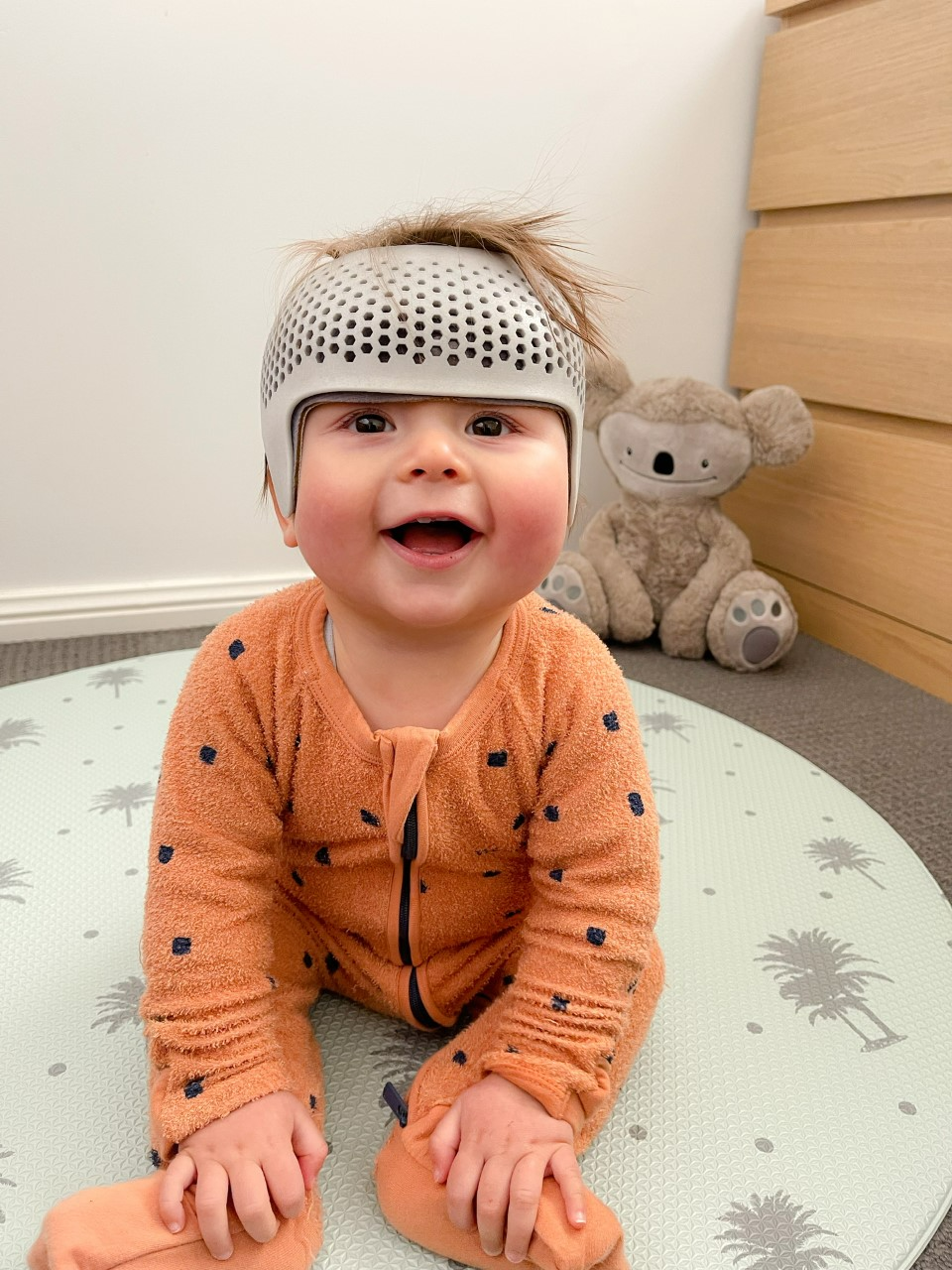 Helmet therapy Client Stories — Access Orthotics