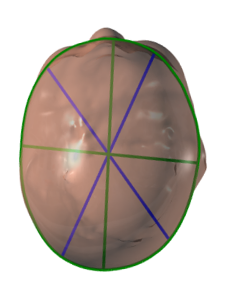 Helmet Therapy — Access Orthotics