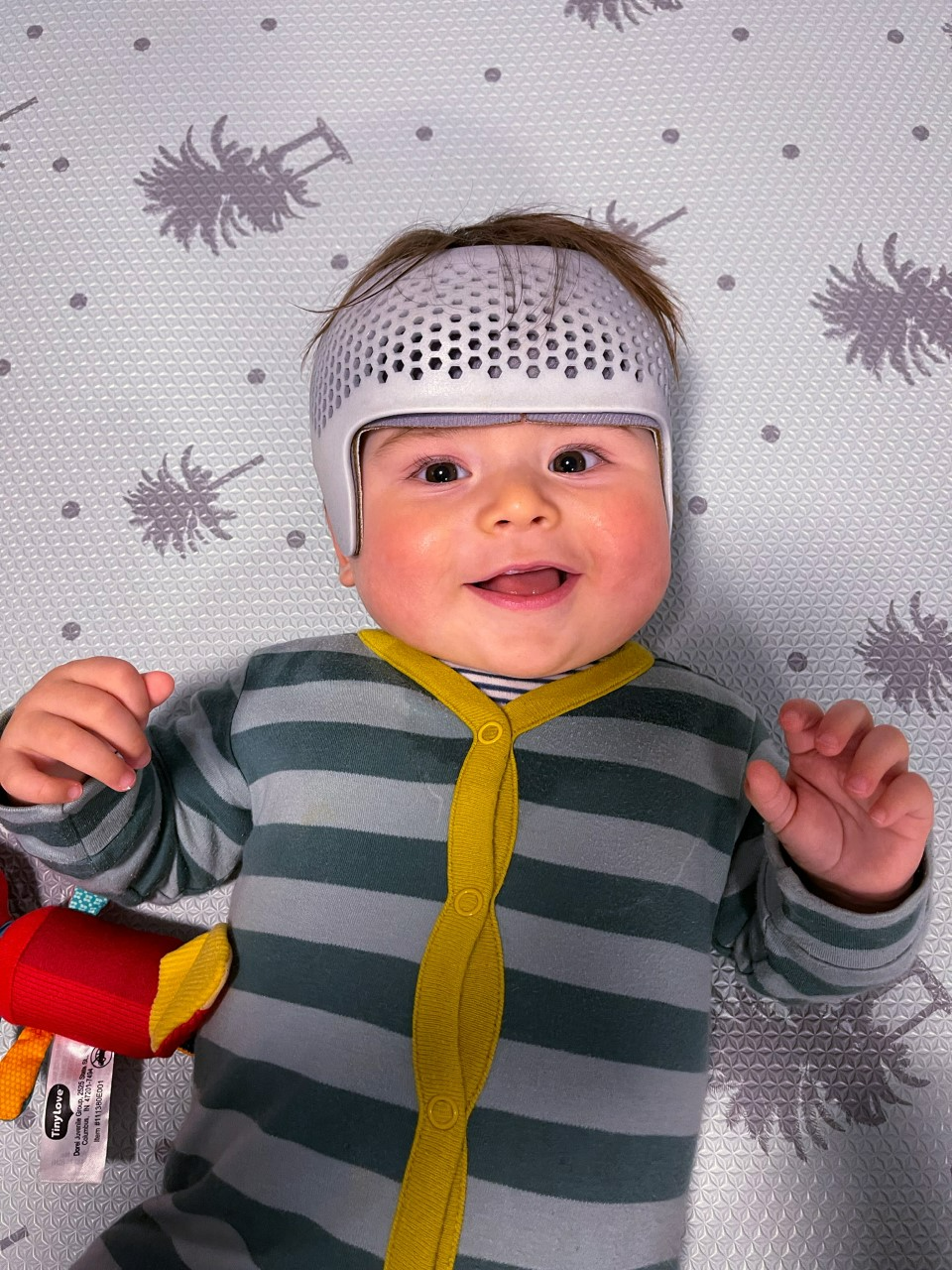 Helmet therapy Client Stories — Access Orthotics