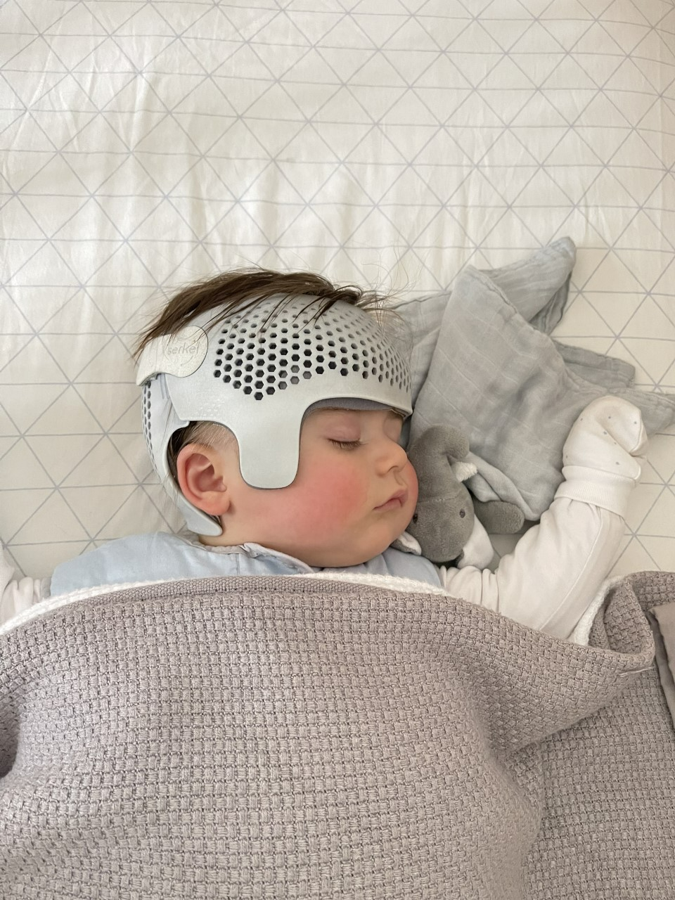 Helmet therapy Client Stories — Access Orthotics