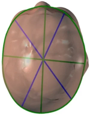 Helmet Therapy — Access Orthotics
