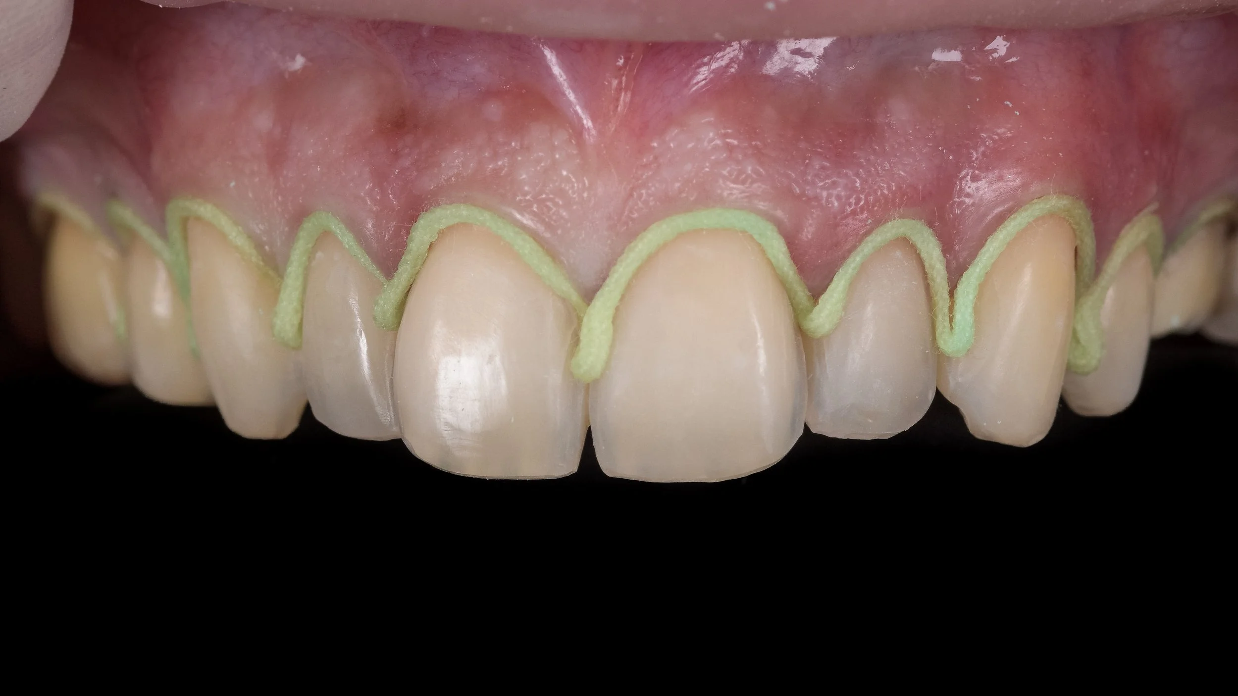 Retraction Cords - Retrax® System — Pascal