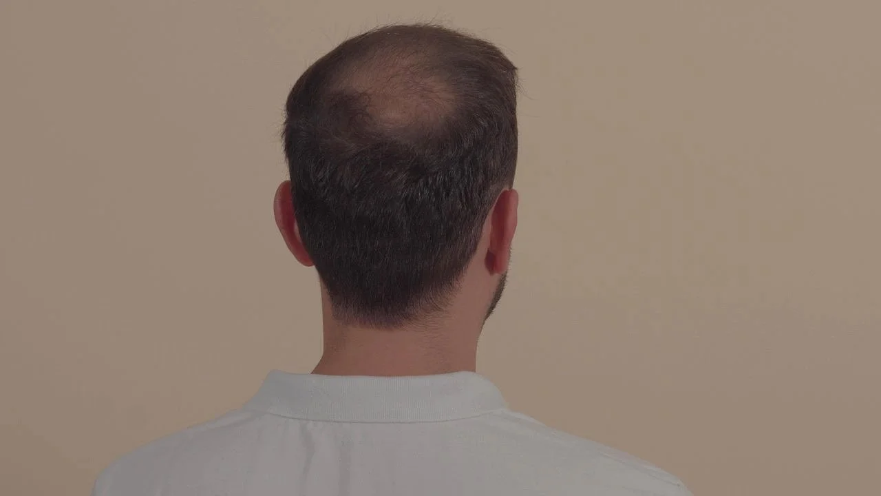 Haarausfall Männer | Ein häufiges Problem — L'EXUR