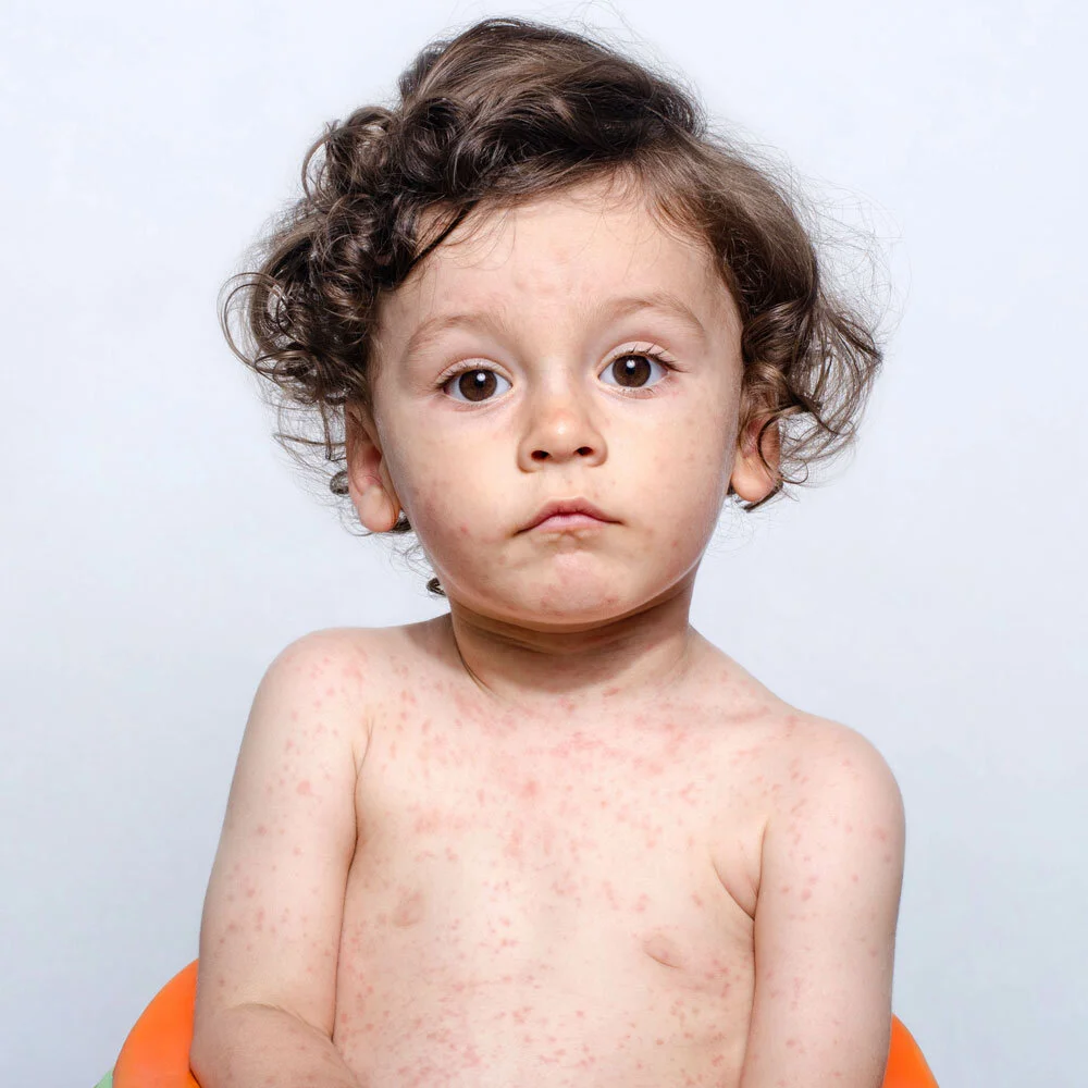 Pediatric Dermatology | Schedule Pediatric Skin Care Today — Virginia ...