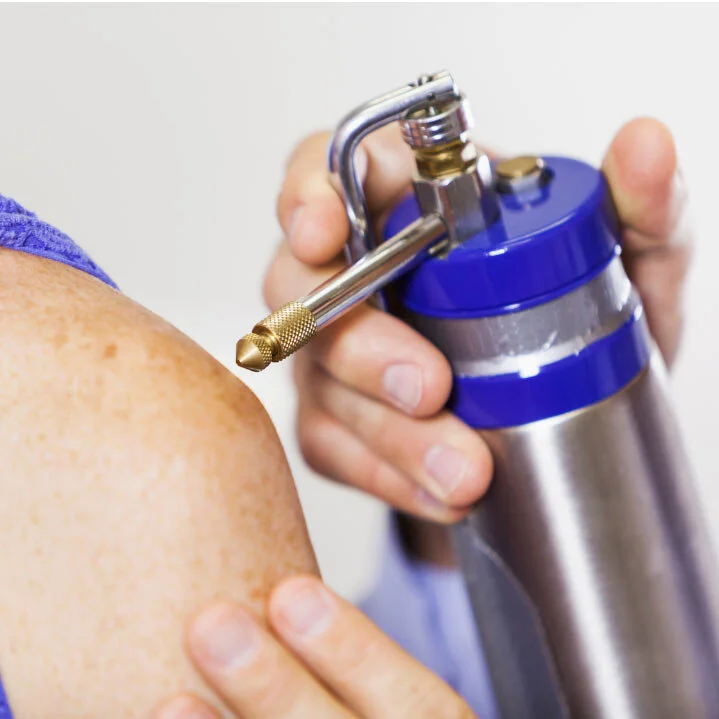 Liquid Nitrogen — Virginia Square Dermatology - Isabela Jones, MD
