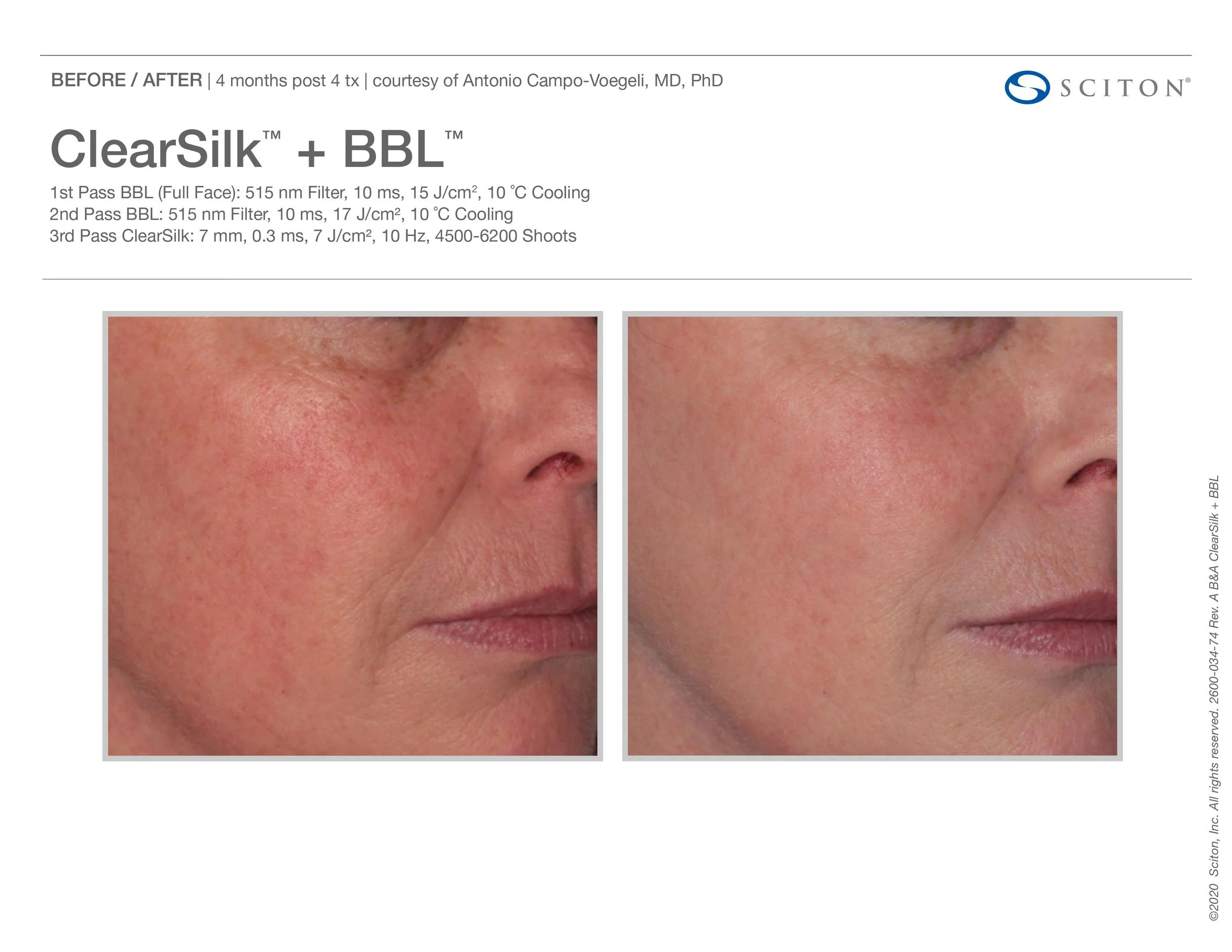 ClearSilk Laser Facial | Clinic 1 - Auckland & Christchurch