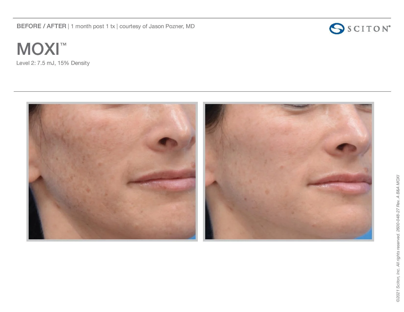 Moxi Laser | Clinic 1 - Auckland & Christchurch