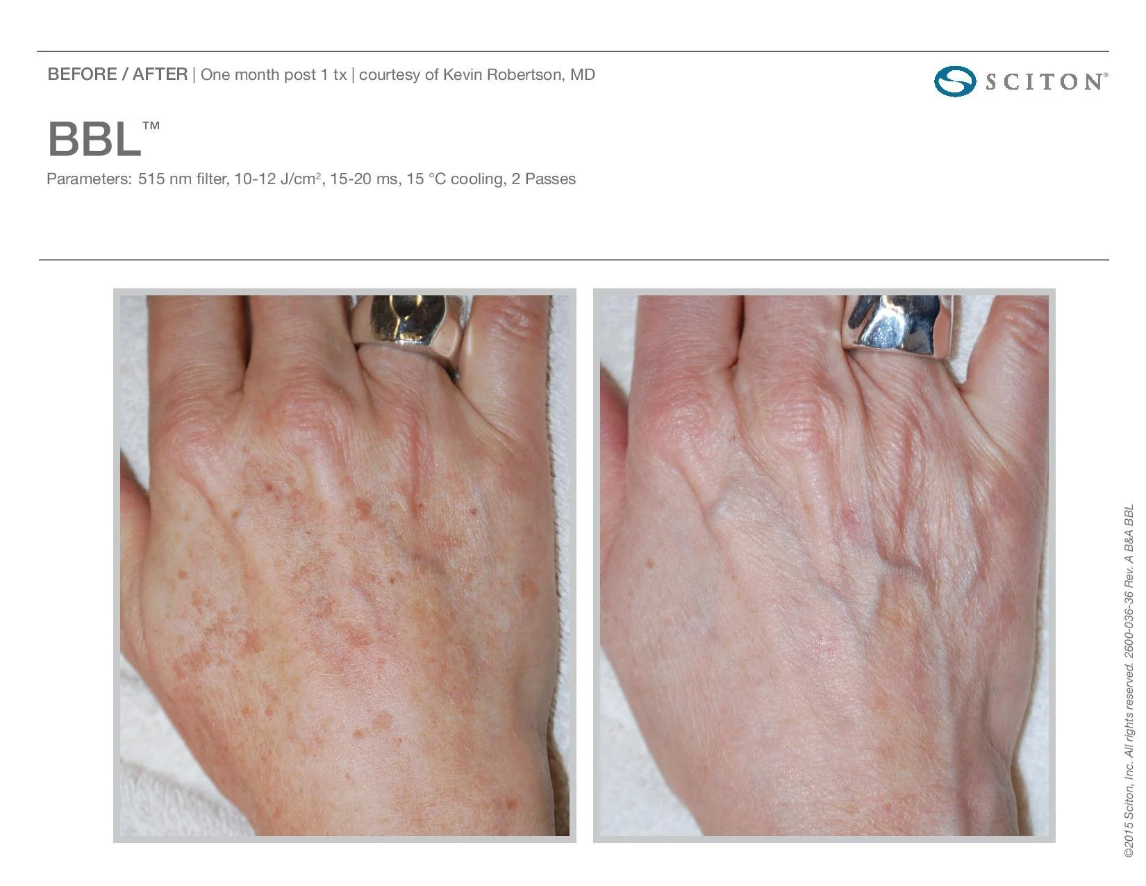 BBL BroadBand Light Therapy | Clinic 1 - Auckland & Christchurch