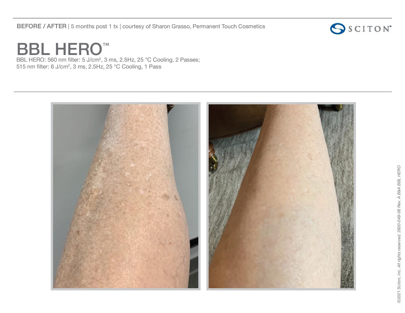 BBL BroadBand Light Therapy | Clinic 1 - Auckland & Christchurch