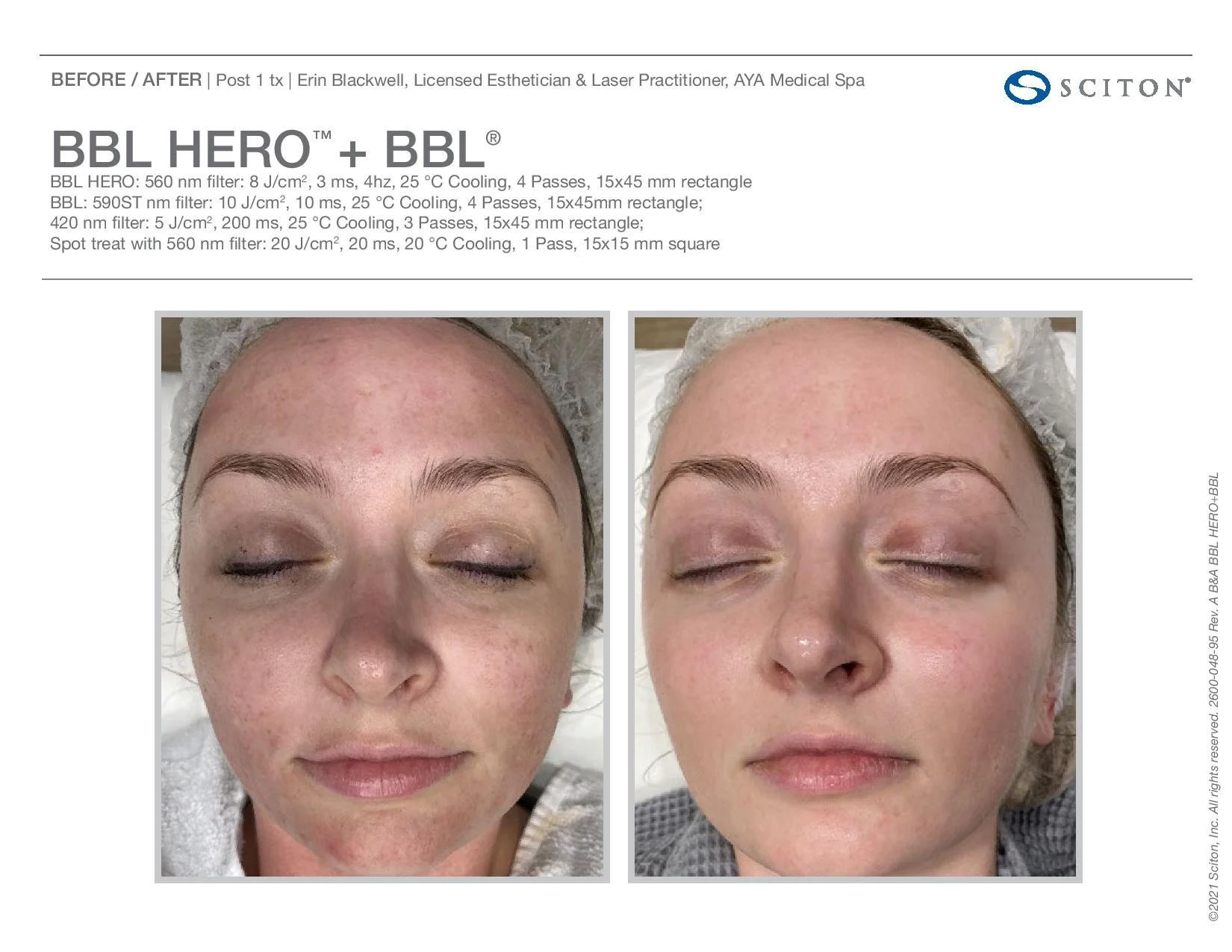 BBL BroadBand Light Therapy | Clinic 1 - Auckland & Christchurch