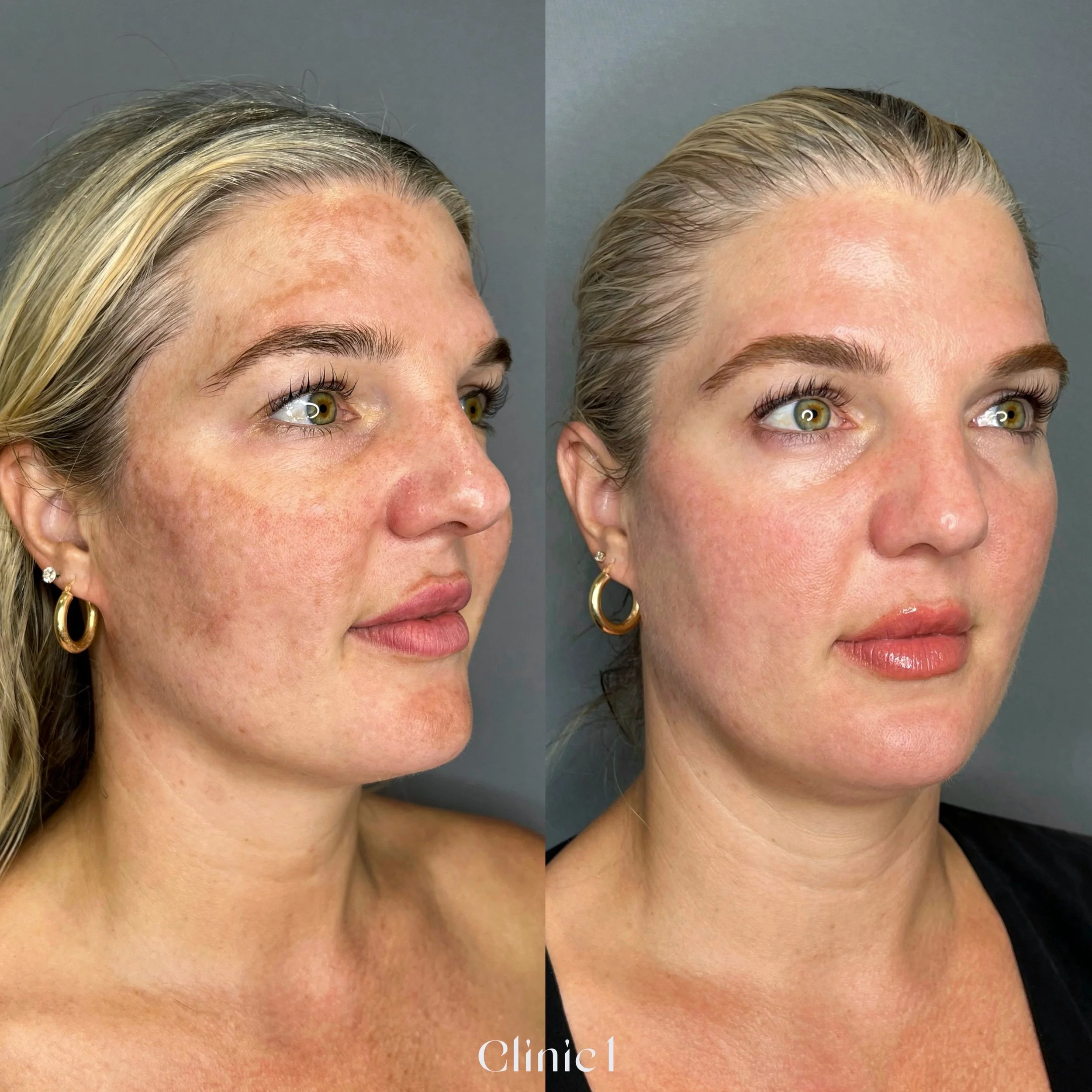 How to treat Melasma with Clinic 1 Aesthetics — Clinic 1 | Auckland ...