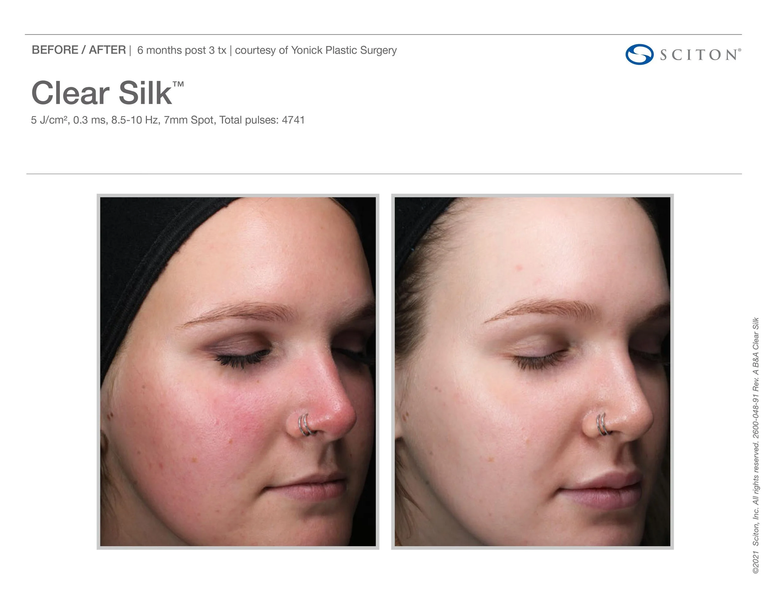 ClearSilk Laser Facial | Clinic 1 - Auckland & Christchurch