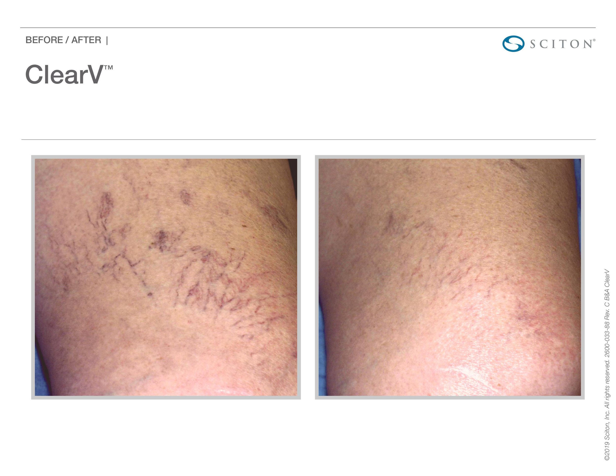 Clear V Vascular Laser | Clinic 1 - Auckland & Christchurch