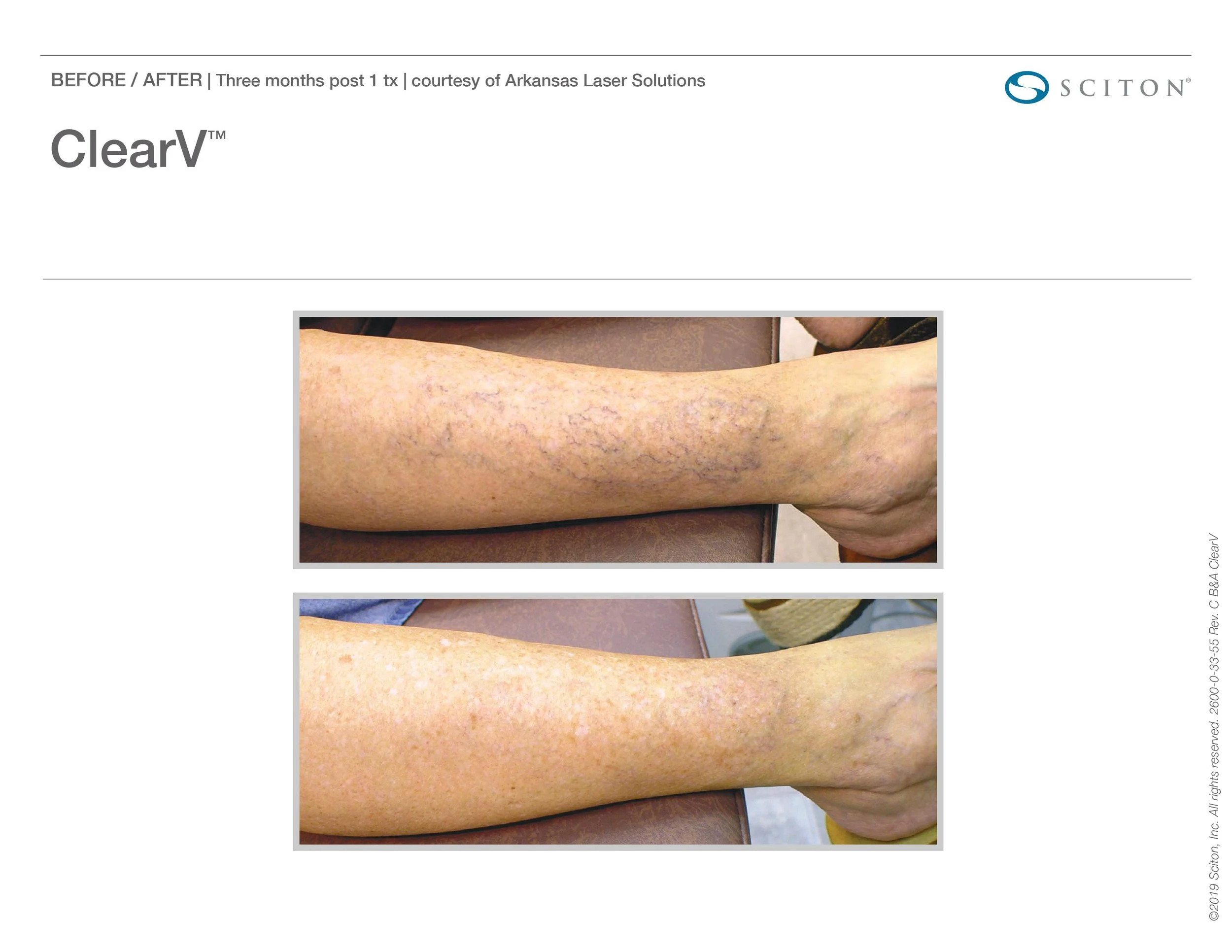 Clear V Vascular Laser | Clinic 1 - Auckland & Christchurch