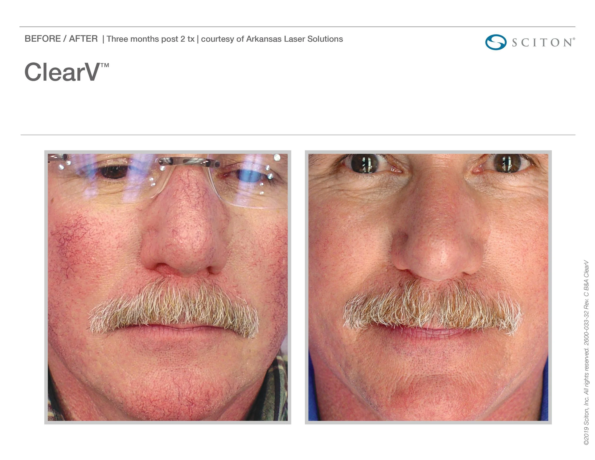 Clear V Vascular Laser | Clinic 1 - Auckland & Christchurch