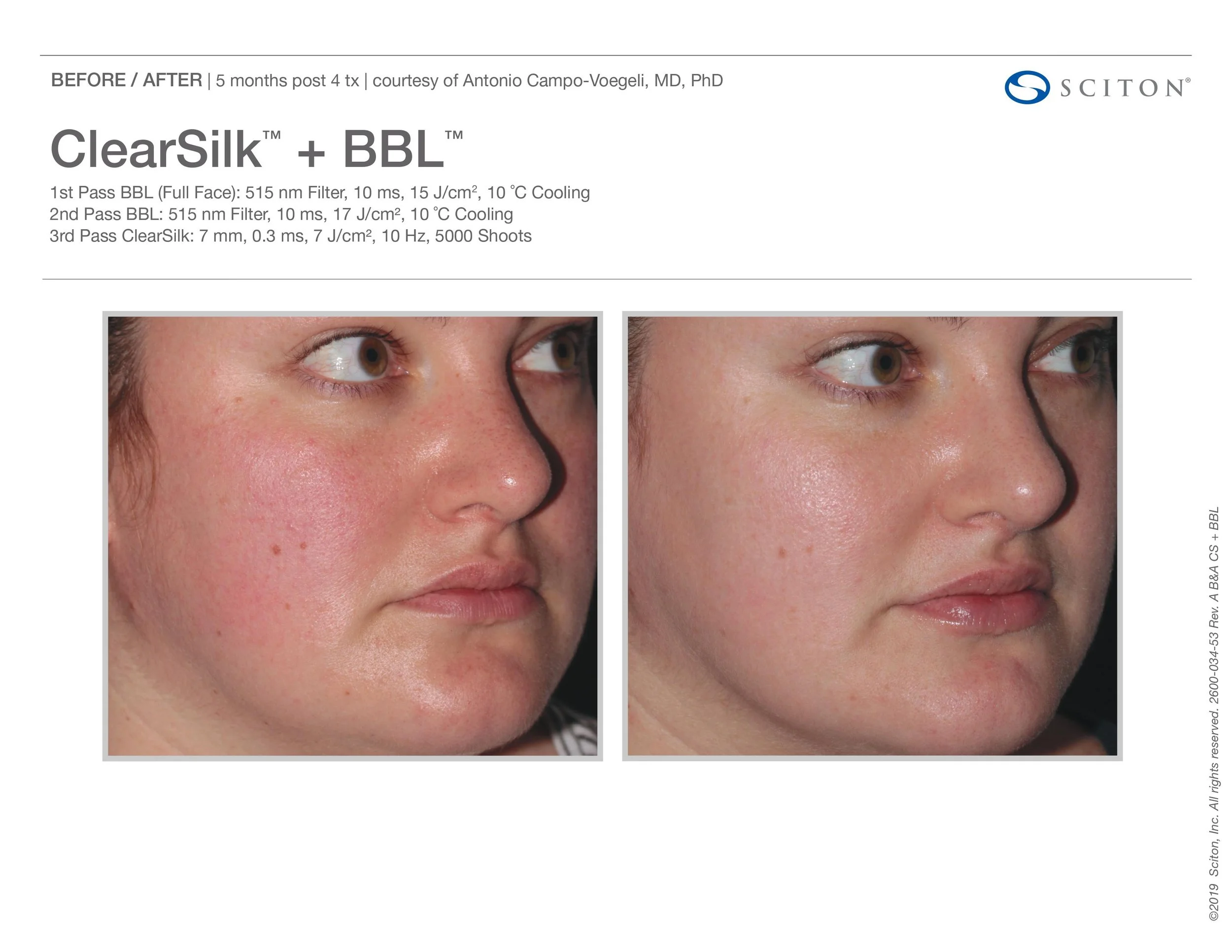 ClearSilk Laser Facial | Clinic 1 - Auckland & Christchurch