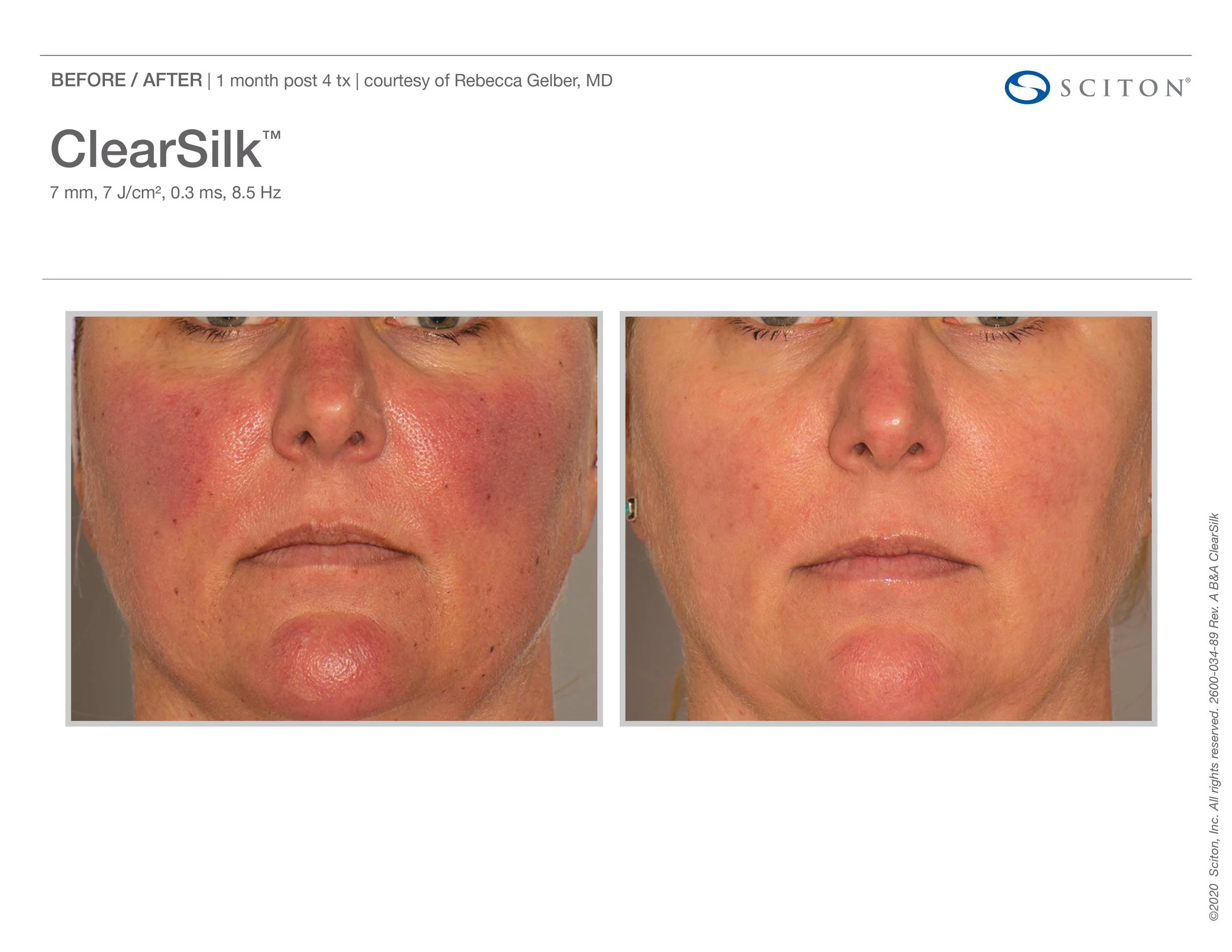 ClearSilk Laser Facial | Clinic 1 - Auckland & Christchurch