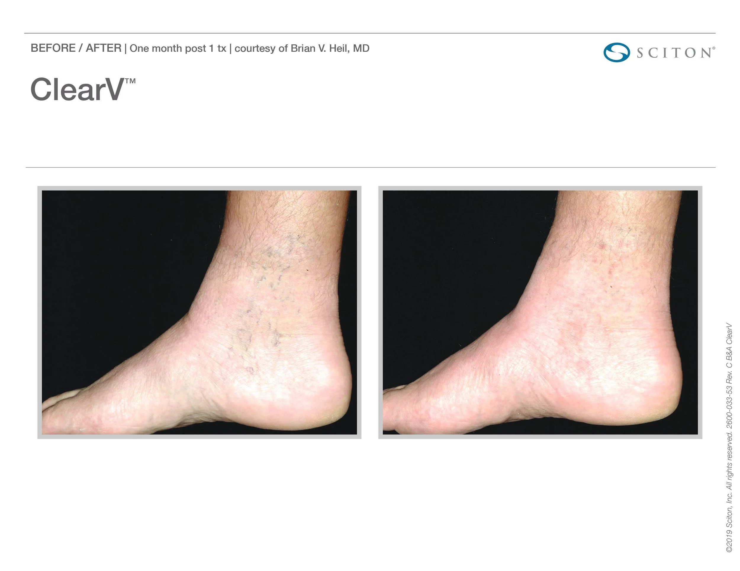 Clear V Vascular Laser | Clinic 1 - Auckland & Christchurch