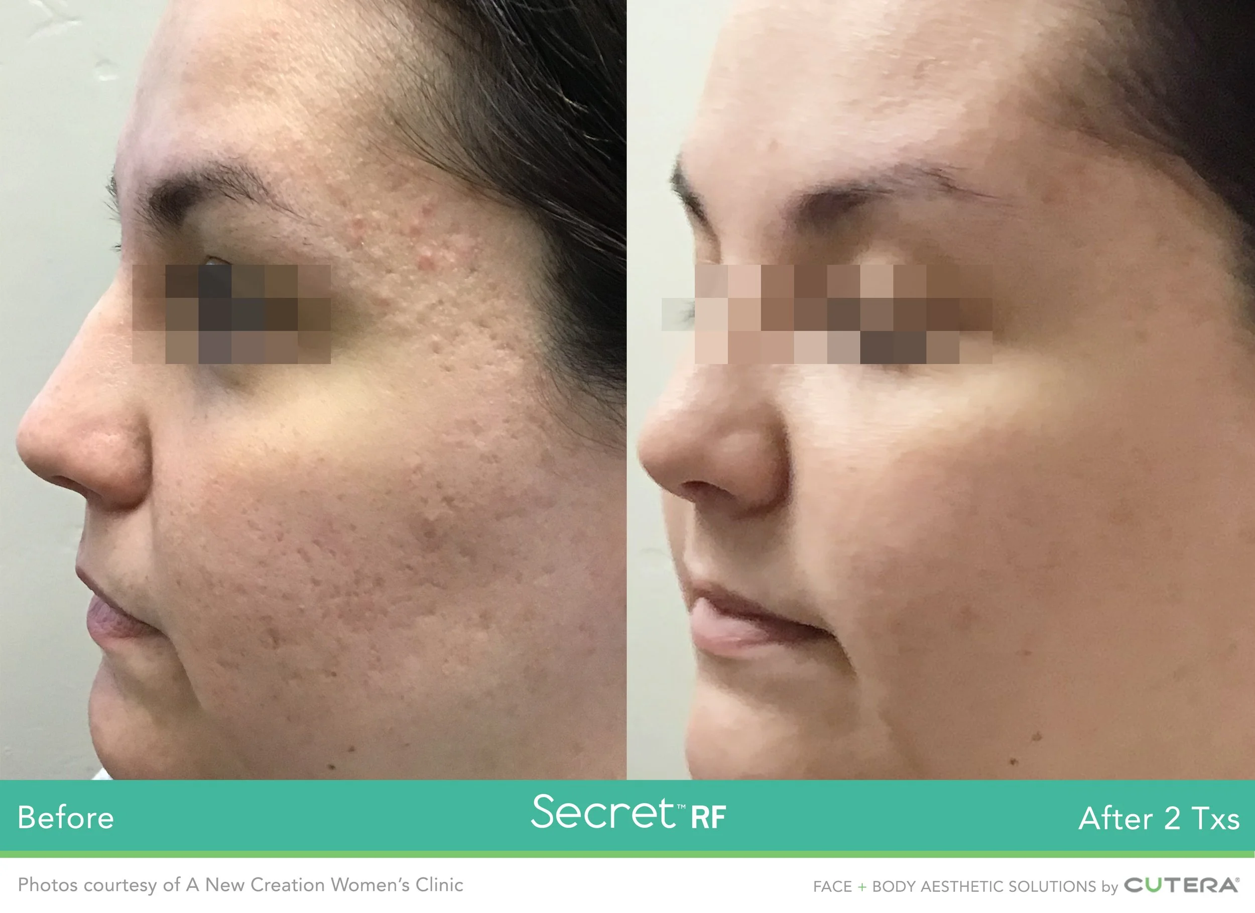 Secret RF Chicago | RF Acne Scar Treatment — Cordial Medical Spa