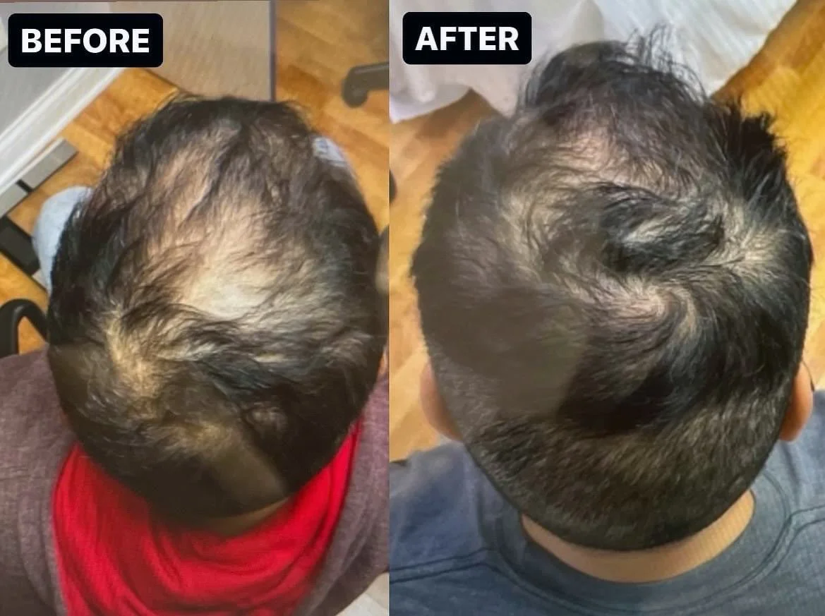 PRP and PRF for Hair Loss — Cordial Medical Spa