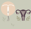 Hormonal IUD vs. Copper IUD: Side Effects, Hormone Impacts, and How to ...