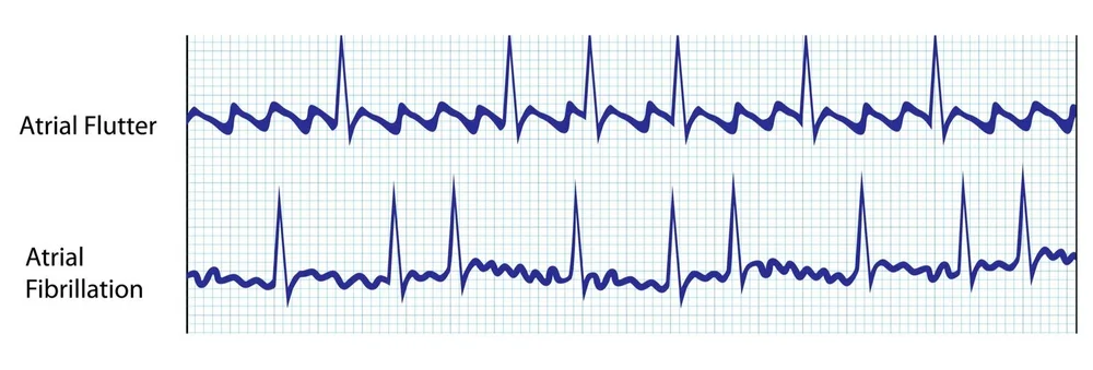 Atrial Fibrillation Vs Atrial Flutter