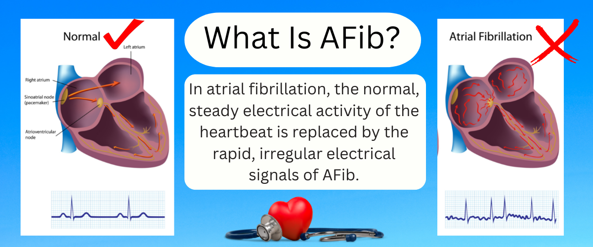 Atrial Fibrillation Symptoms Causes And Treatment What Is AFib